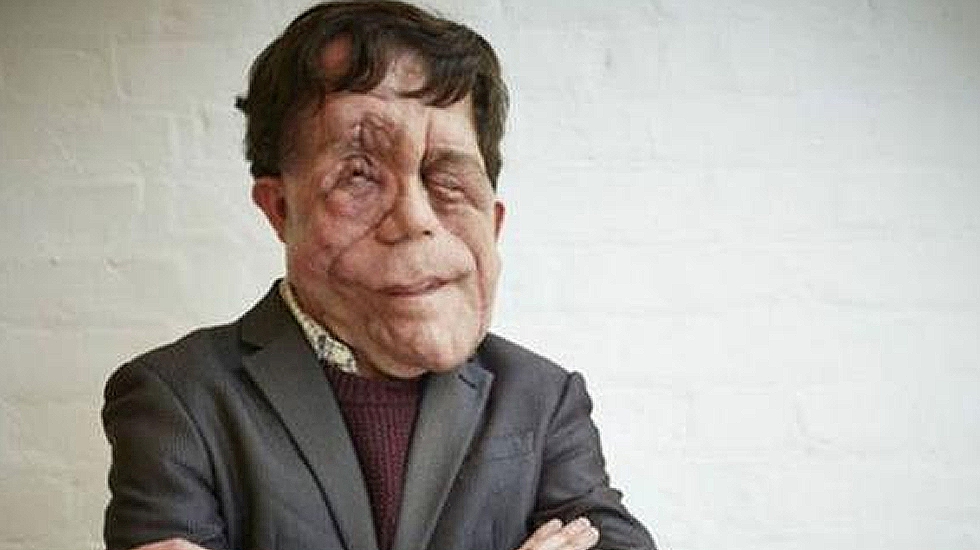 La emotiva historia del actor Adam Pearson: De fenómeno de circo a la ...